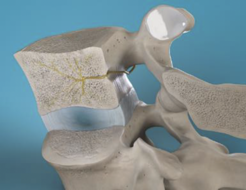 Basivertebral Nerve Ablation Newsletter - Dr. David Provenzano
