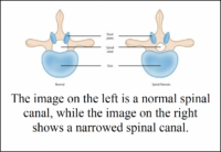 Minimally Invasive Lumbar Decompression (MILD) - Dr. David Provenzano