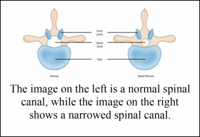 Minimally Invasive Lumbar Decompression (MILD) - Dr. David Provenzano