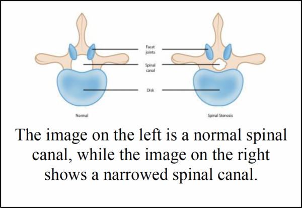 Minimally Invasive Lumbar Decompression (MILD) - Dr. David Provenzano
