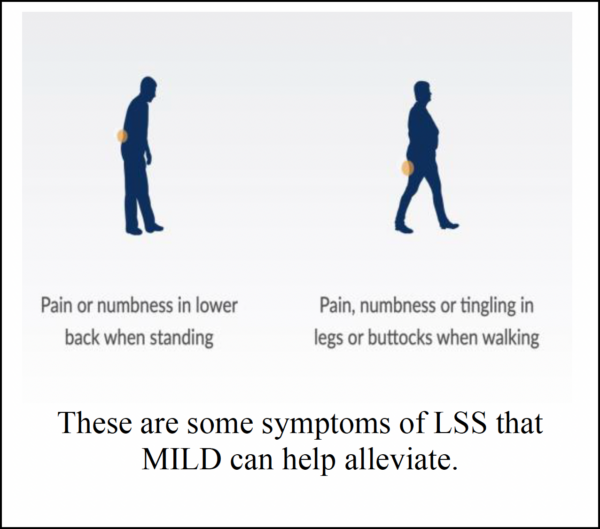 Minimally Invasive Lumbar Decompression (MILD) - Dr. David Provenzano